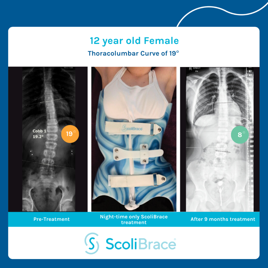 Unlocking Scoliosis: Understanding Causes & Treatment